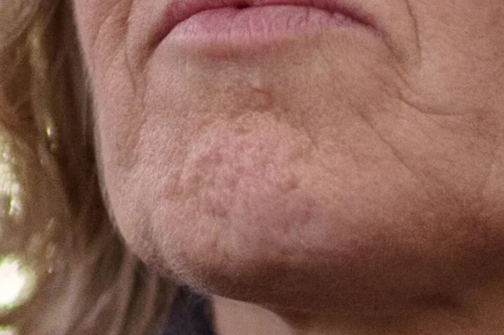 Dimpled Chin Treatments - Freyja Medical