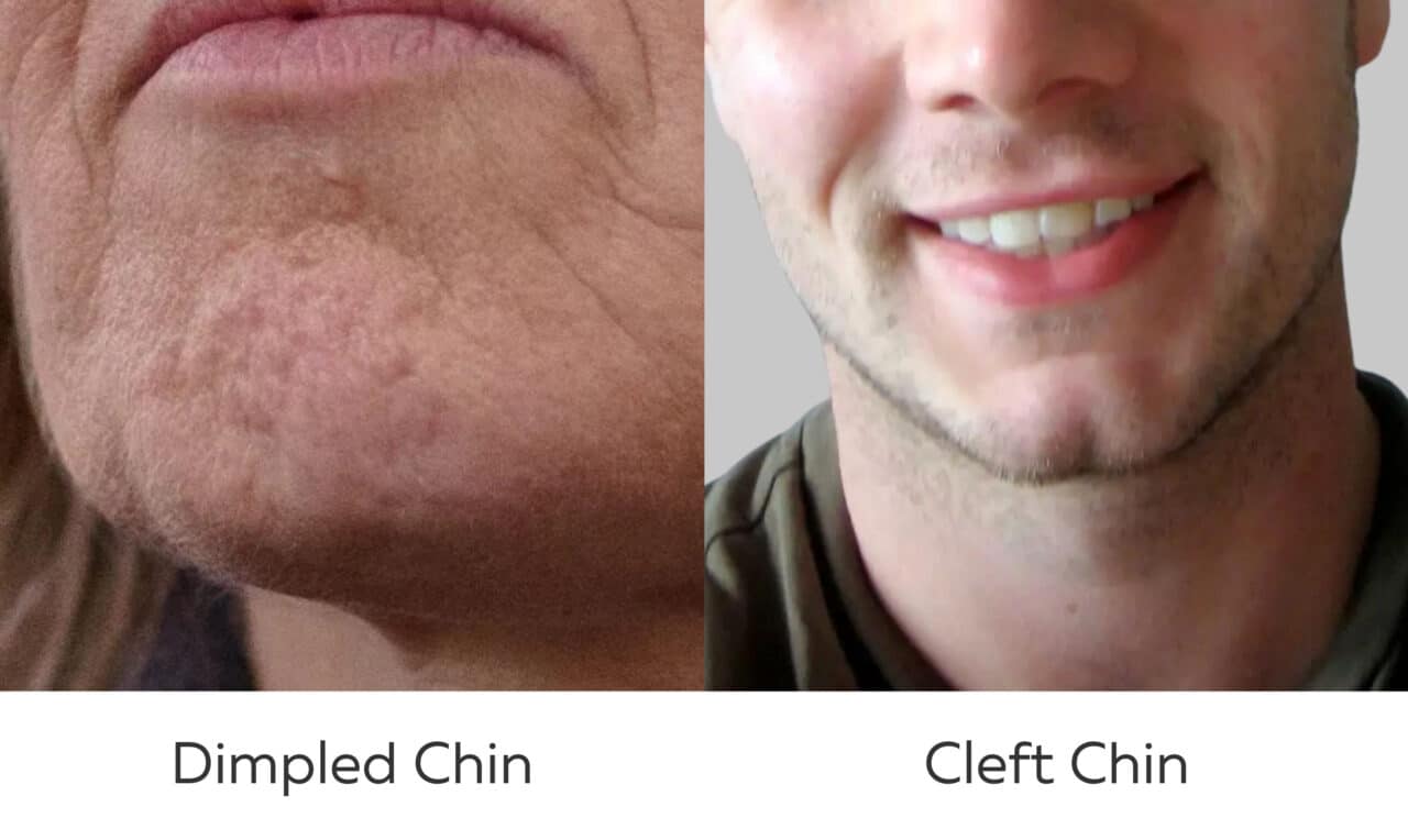 Dimpled Chin Treatments - Freyja Medical