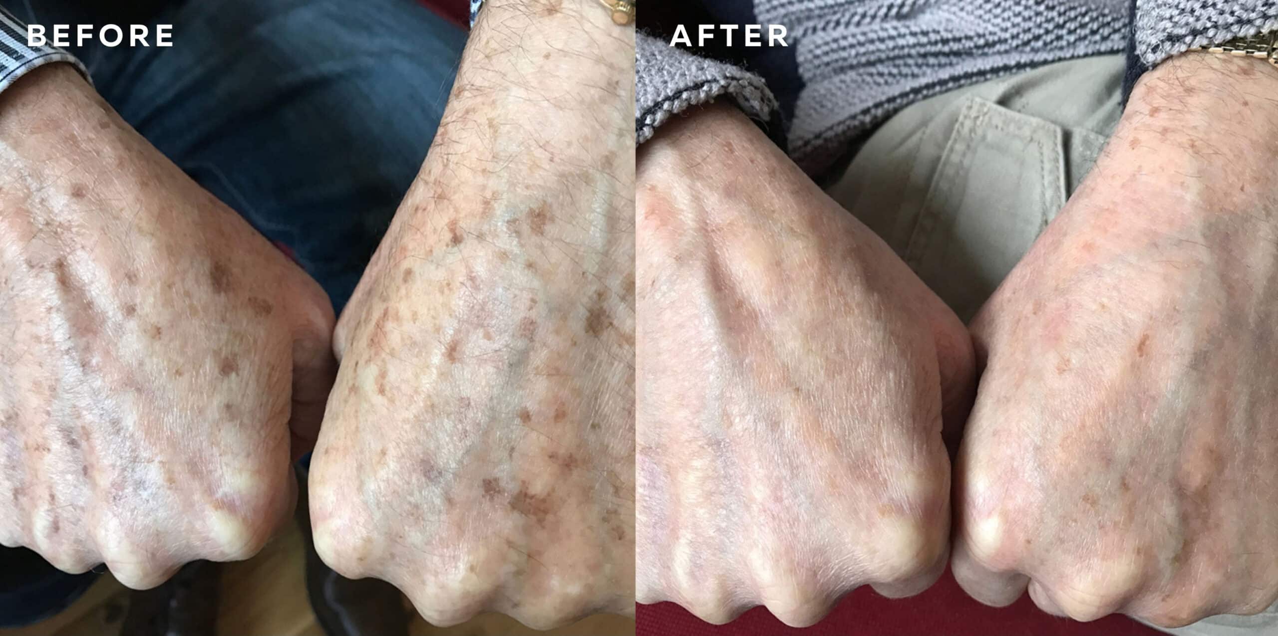 Ageing Hands - Freyja Medical