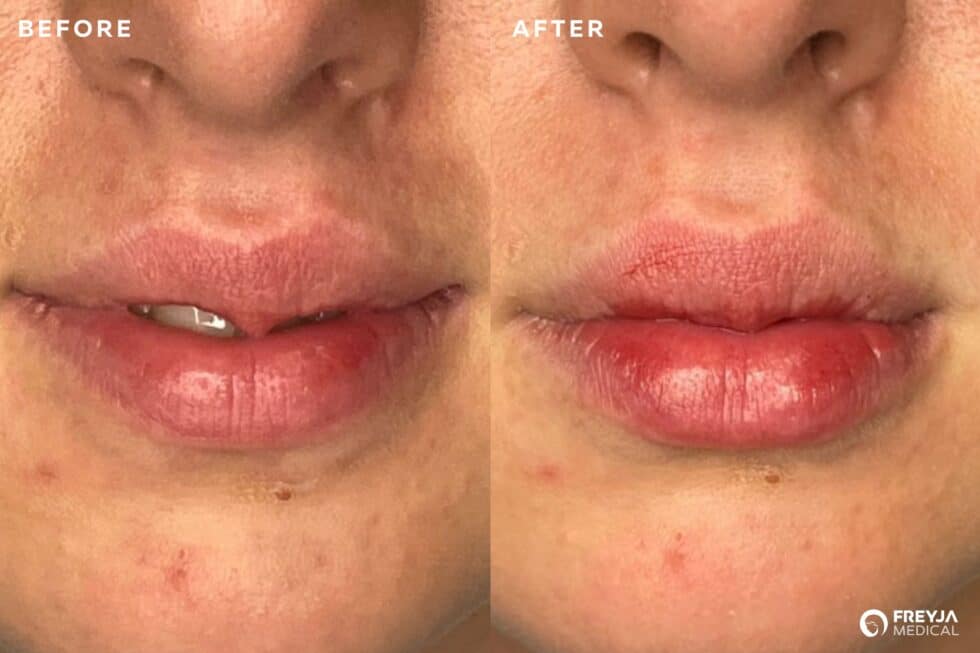Uneven Lip Shape - Freyja Medical