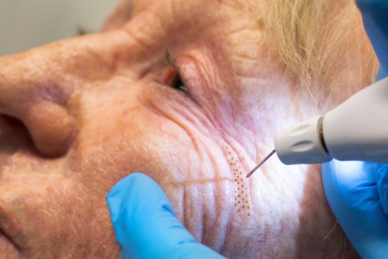 Introducing Plexr Plus: Non-Surgical Skin Tightening - Freyja Medical