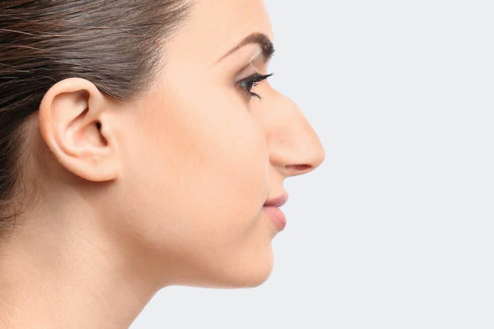 Nose Bump (Dorsal Hump) - Freyja Medical