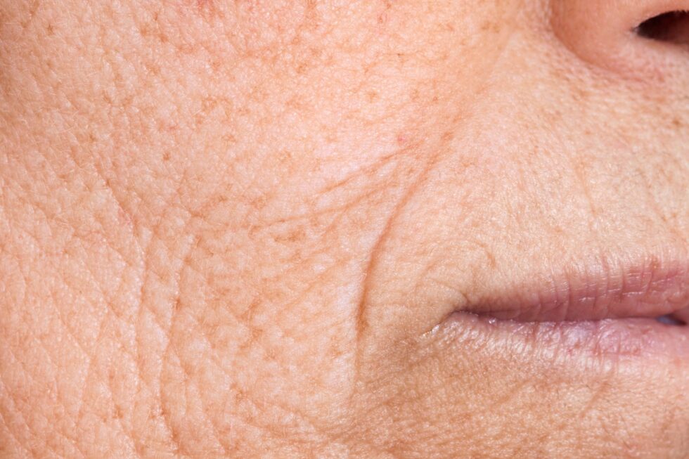 Static Wrinkles vs Dynamic Wrinkles: What's the Difference? - Freyja ...