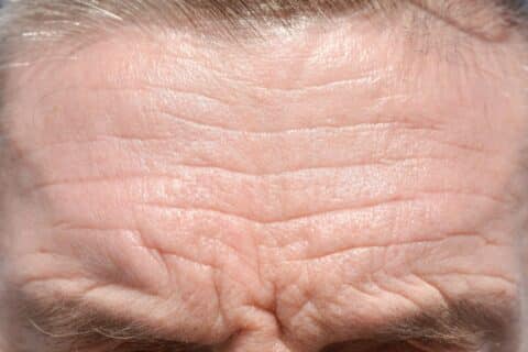 Static Wrinkles vs Dynamic Wrinkles: What's the Difference? - Freyja ...