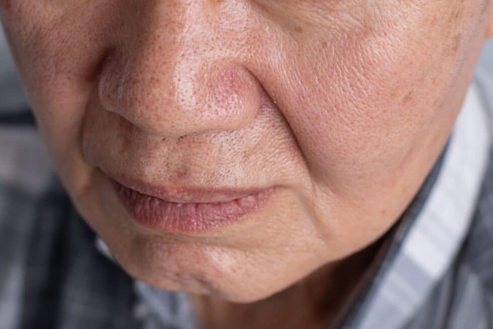 Nasolabial Folds (Smile Lines) - Freyja Medical