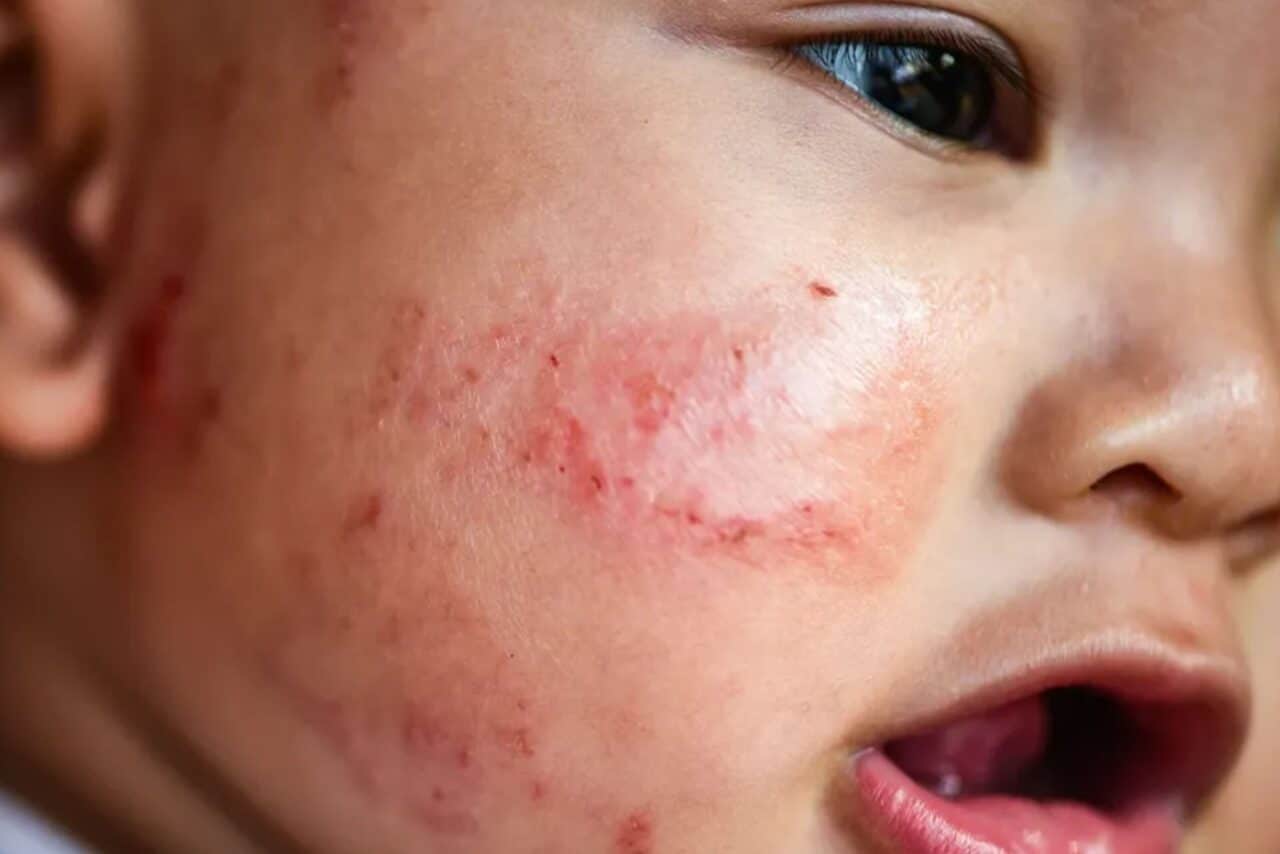 Childhood Rashes: When to Seek a Dermatologist - Freyja Medical