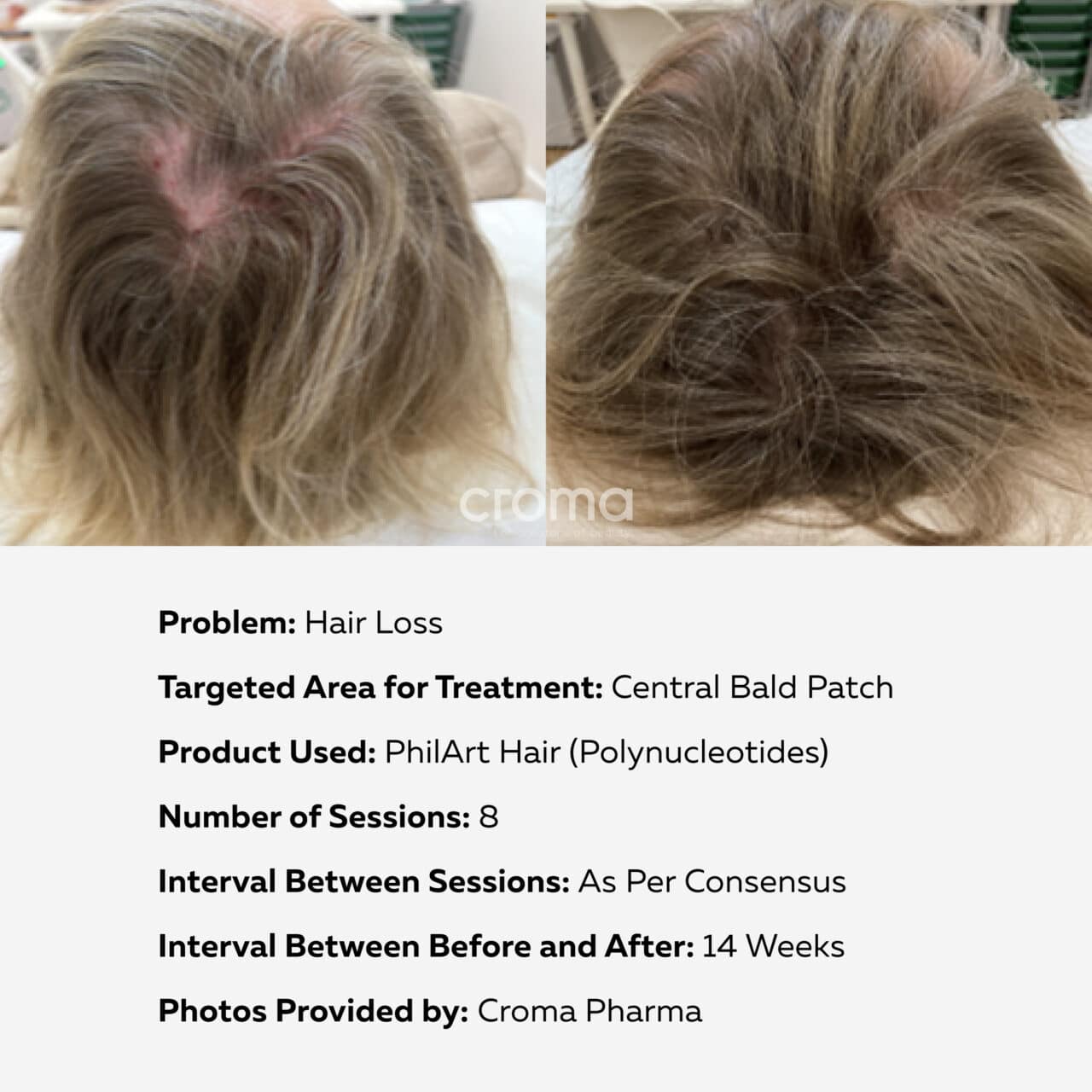 Polynucleotides What to Expect: Before, During and After - Freyja Medical