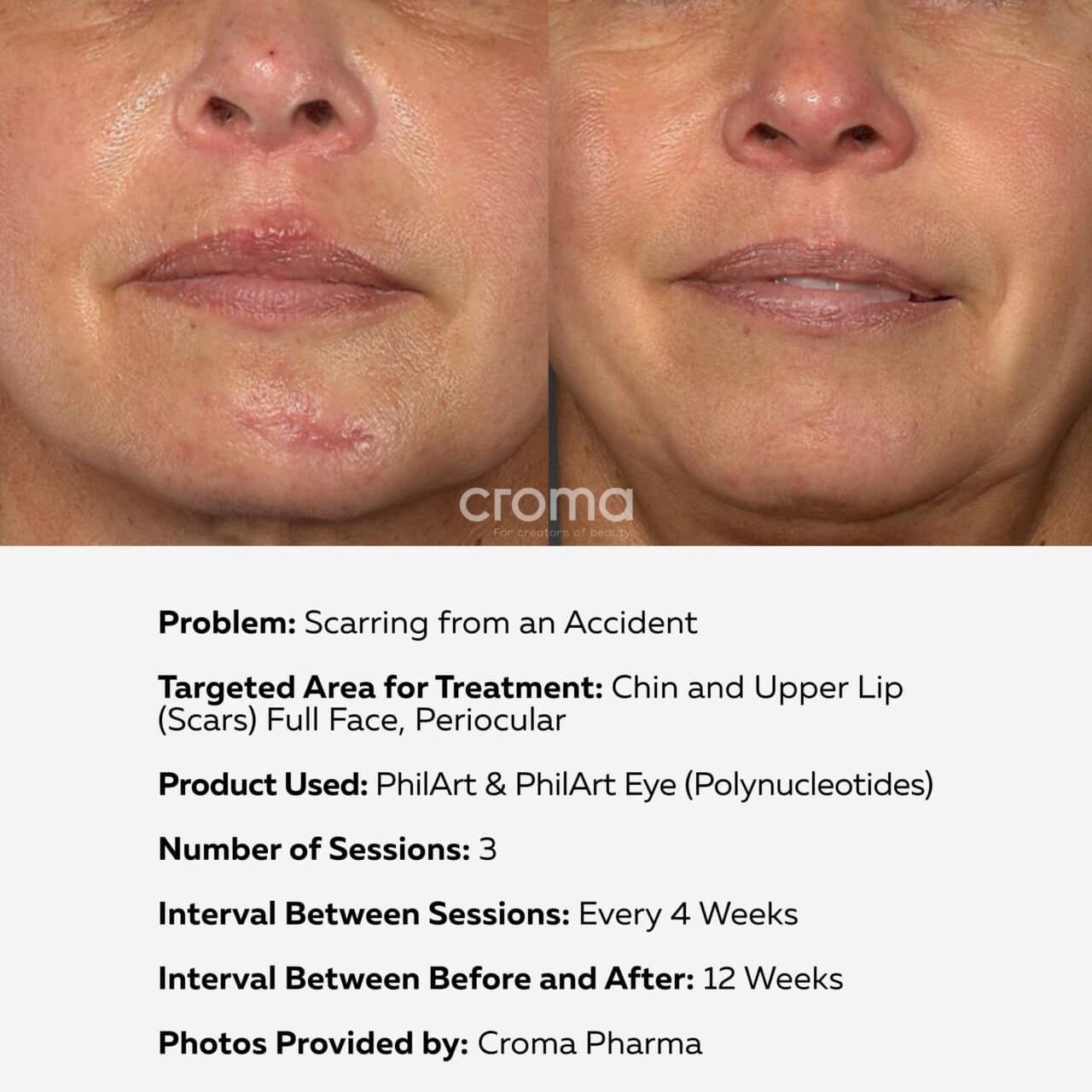 Polynucleotides What to Expect: Before, During and After - Freyja Medical